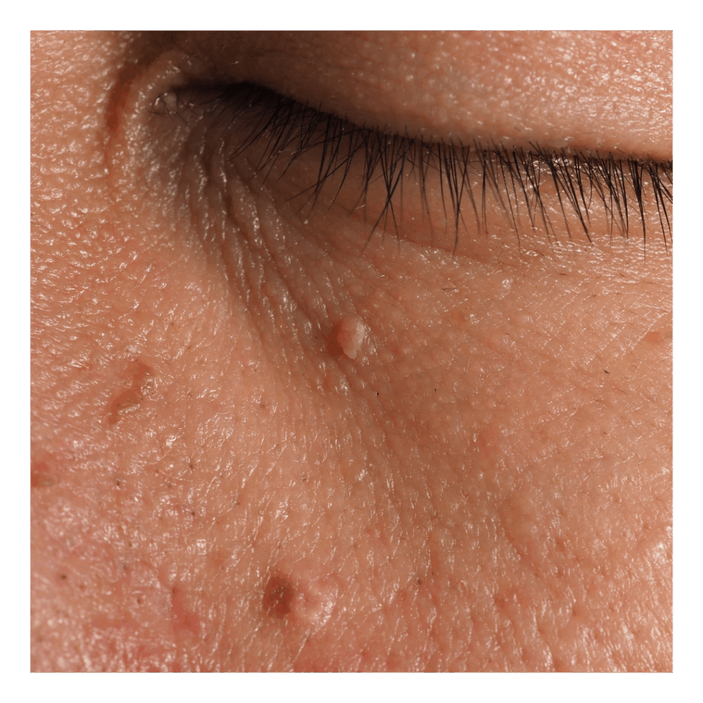 Warts Treatment in Singapore - Nueva Clinic
