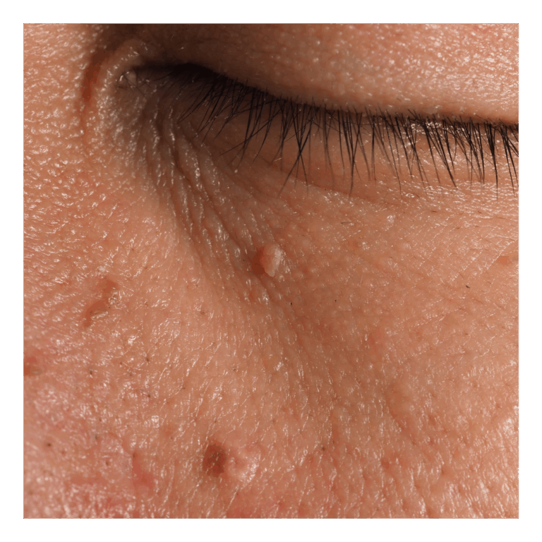 Warts Treatment in Singapore - Nueva Clinic